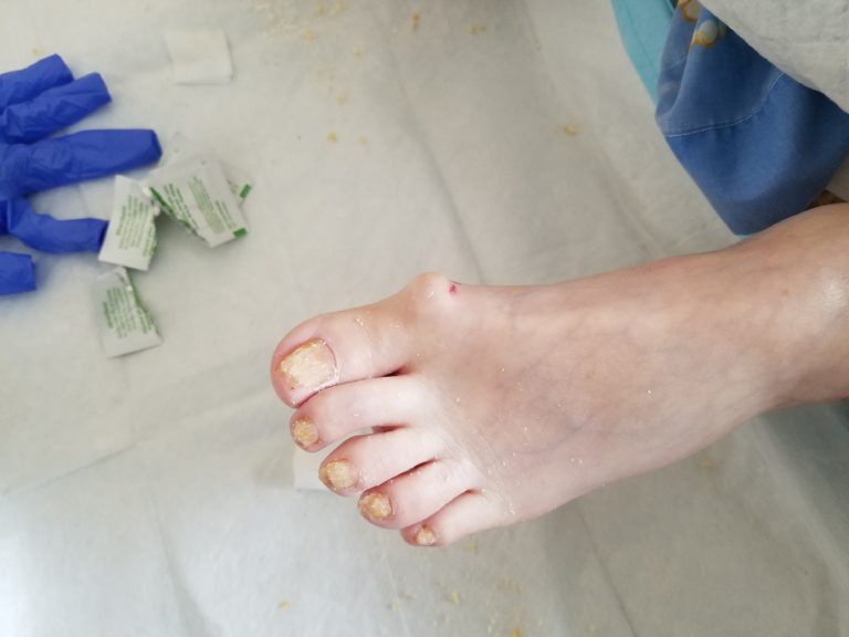 Gallery Of Foot Diseases / Abnormalities | Foot Care Specialist ...